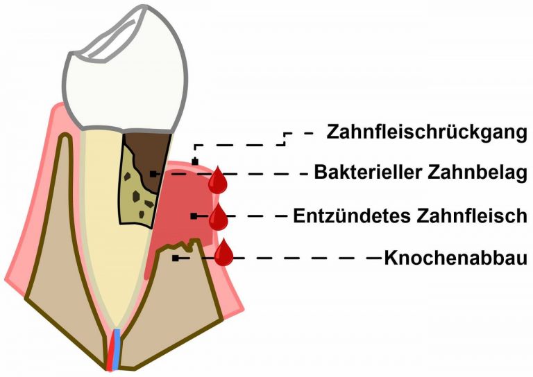 Parodontologie / Parodontitis Behandlung Wien - Dr. Achim, 1070 Wien